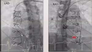 Neovasc Coronary Sinus Reducer, Al Mouwasat Hospital, Dammam - Zahrawi
